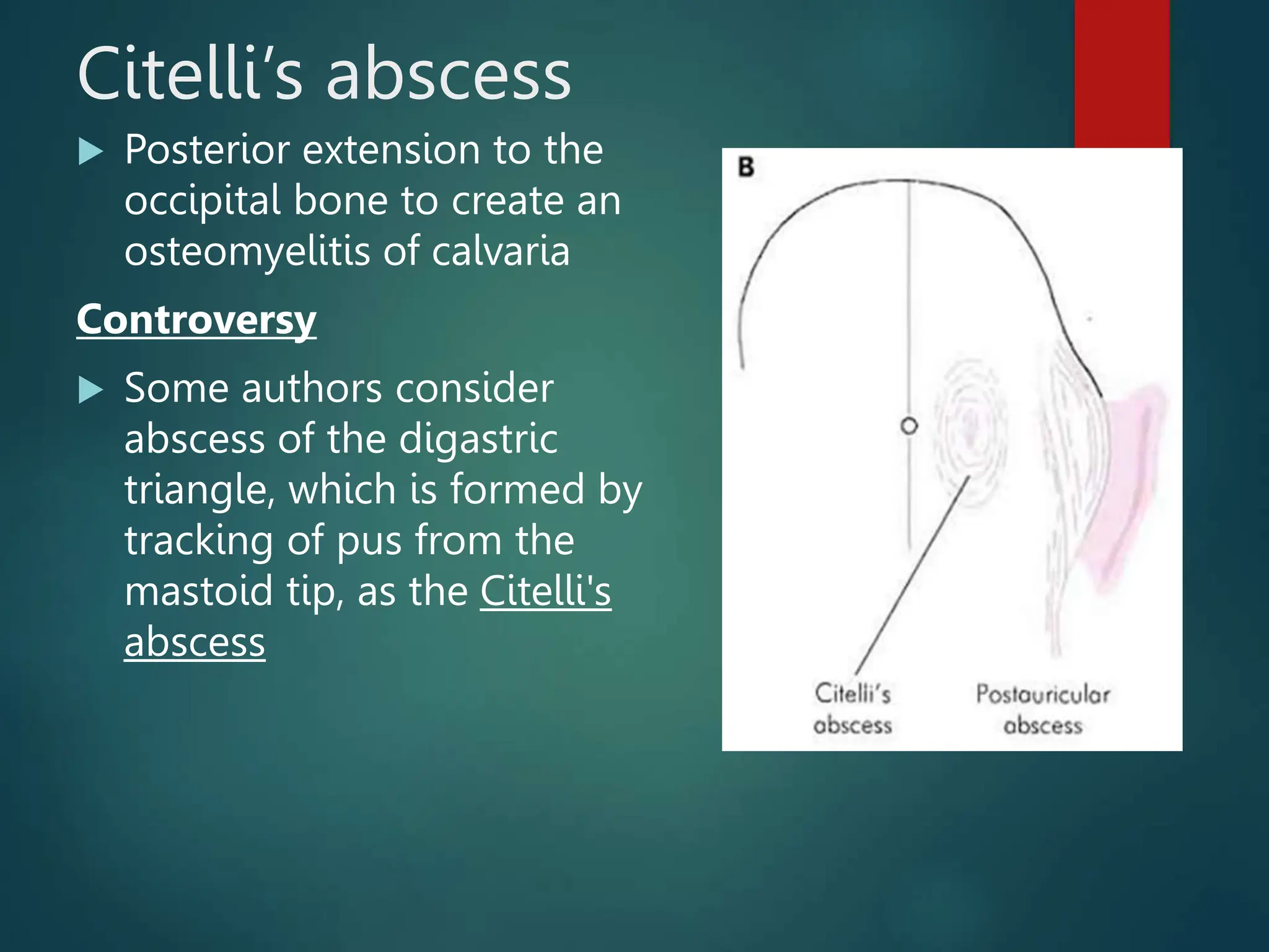 MASTOID ABSCESS, ear nose and throat presentation | PPT