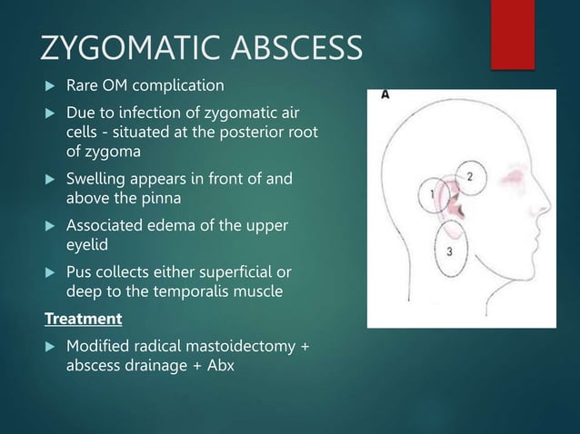 Mastoid Abscess Ear Nose And Throat Presentation Ppt