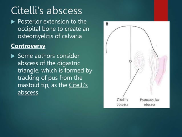 MASTOID ABSCESS, ear nose and throat presentation | PPT