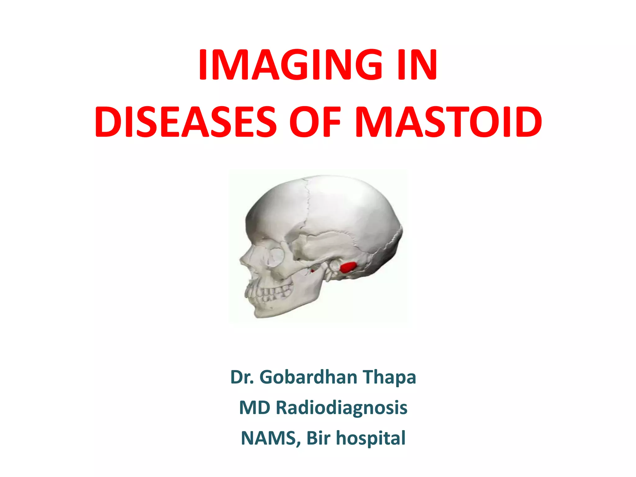 Mastoid diseases imaging | PPTX