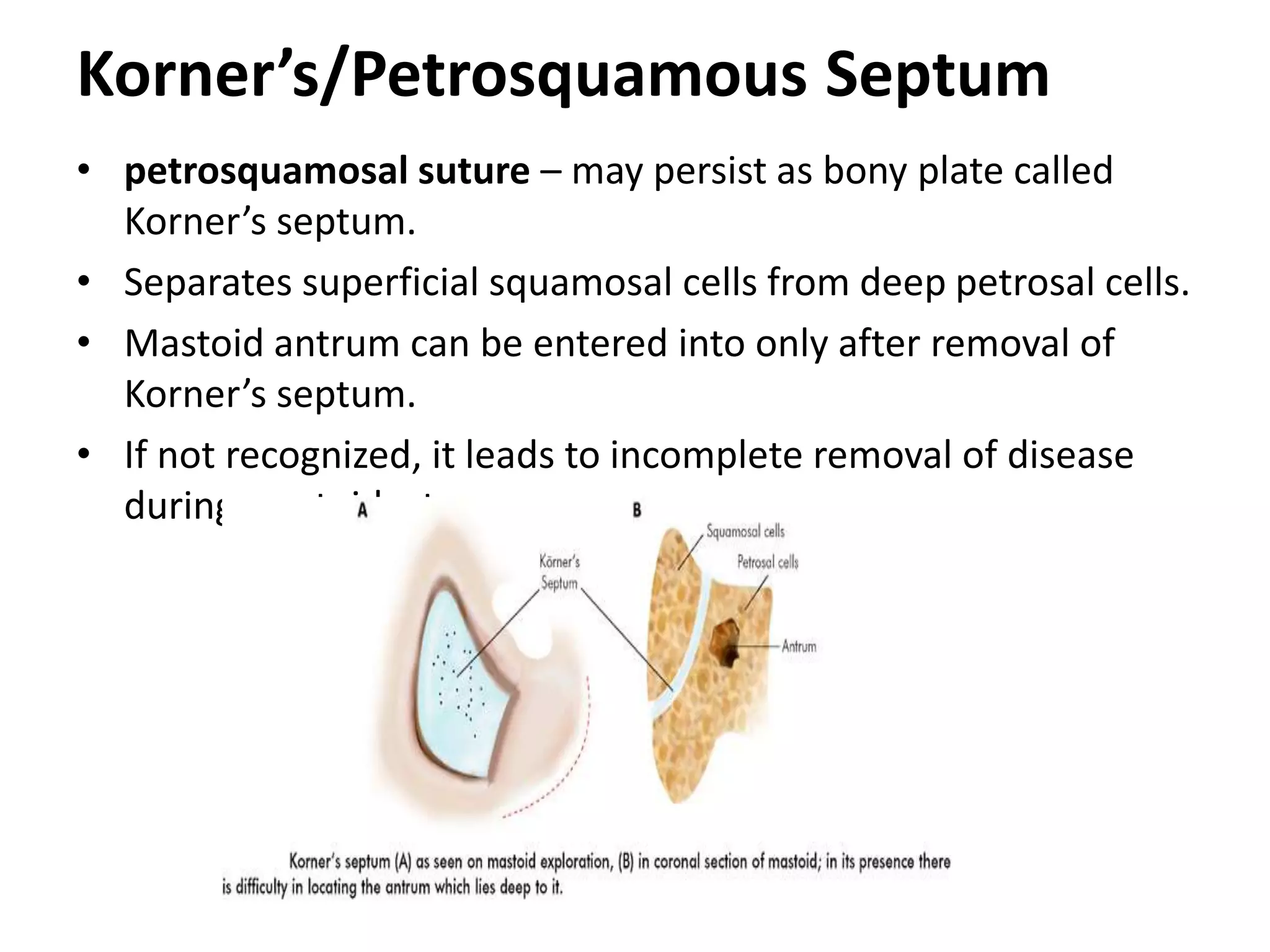 Mastoid diseases imaging | PPTX