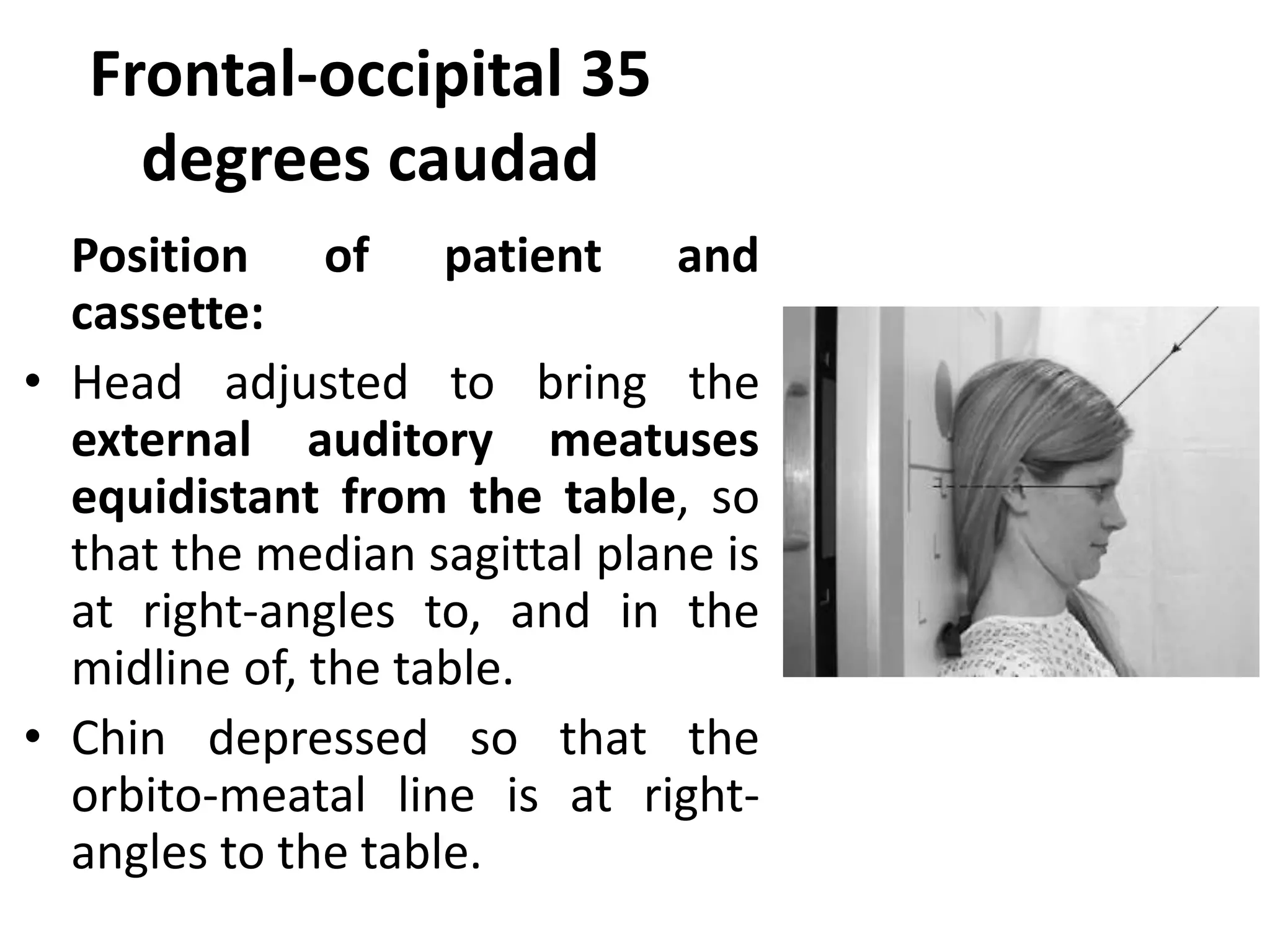 Mastoid diseases imaging | PPTX