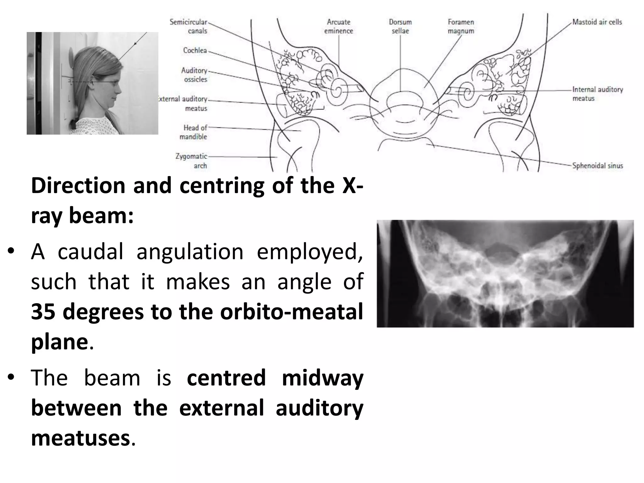Mastoid diseases imaging | PPTX
