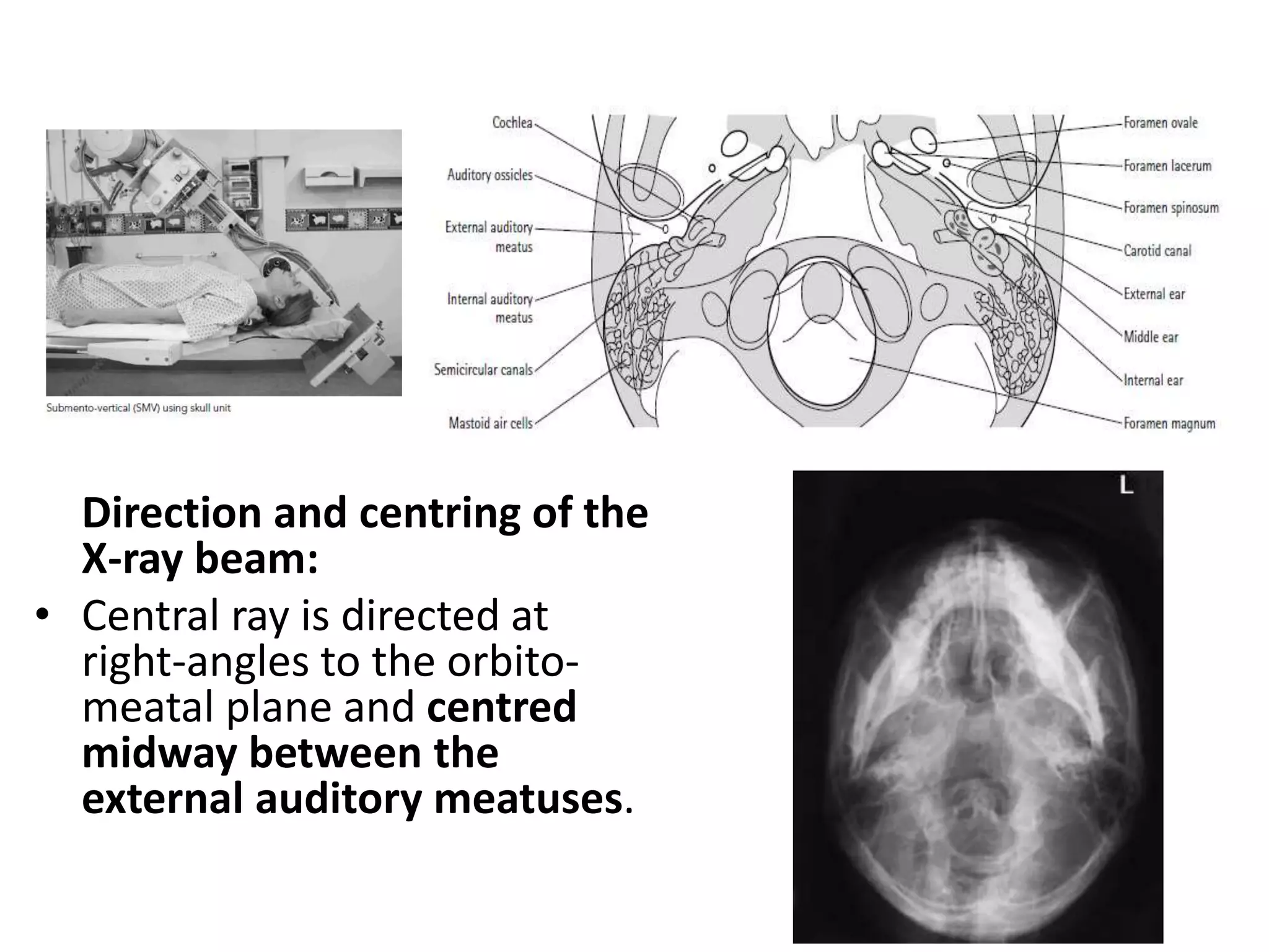 Mastoid diseases imaging | PPTX