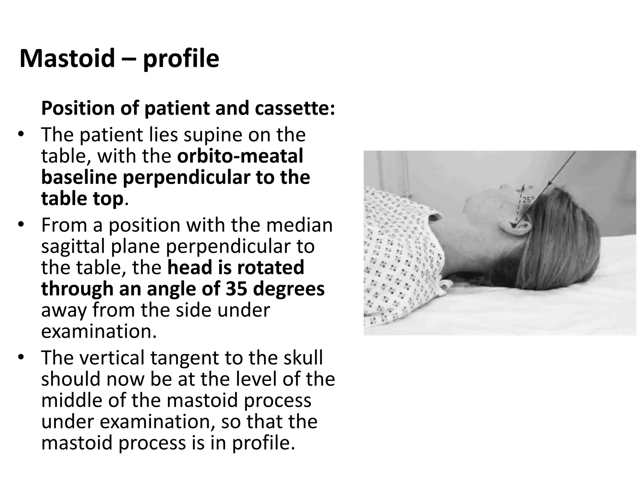 Mastoid diseases imaging | PPTX