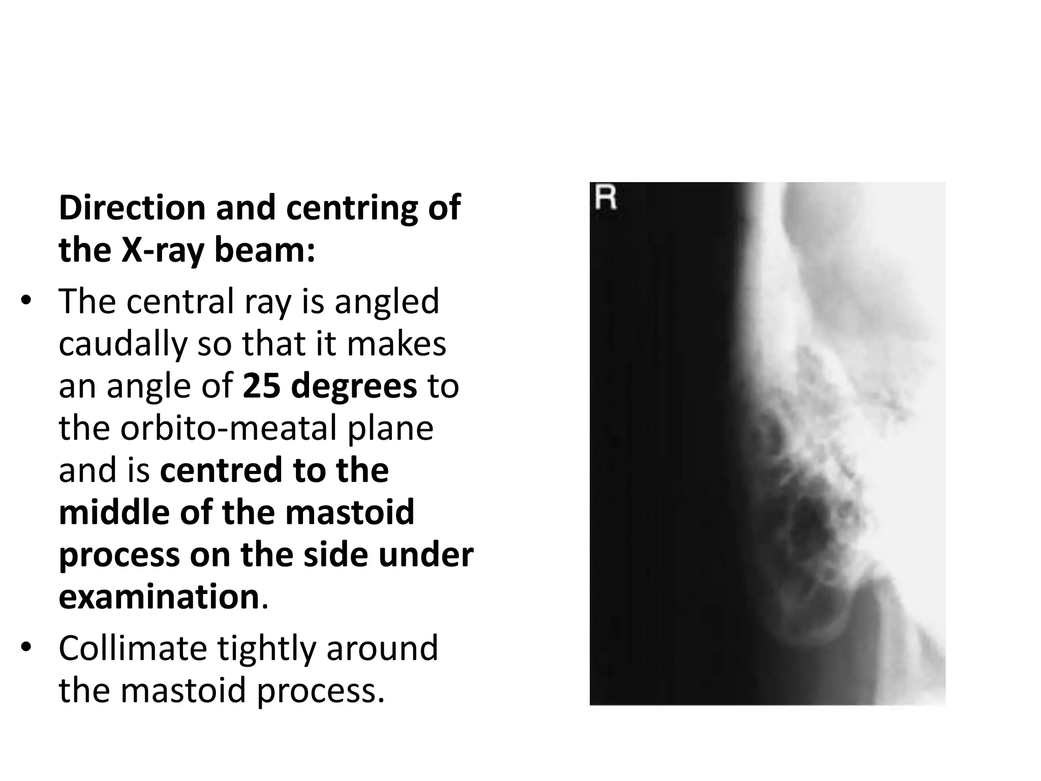 Mastoid diseases imaging | PPTX