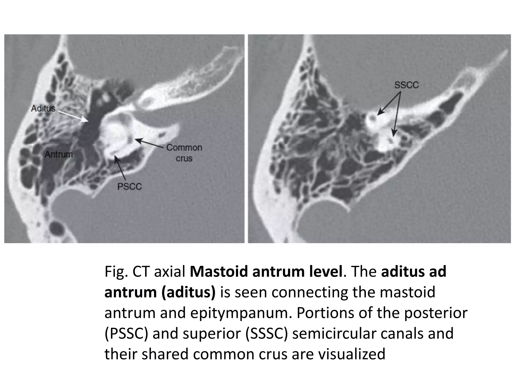 Mastoid diseases imaging | PPTX