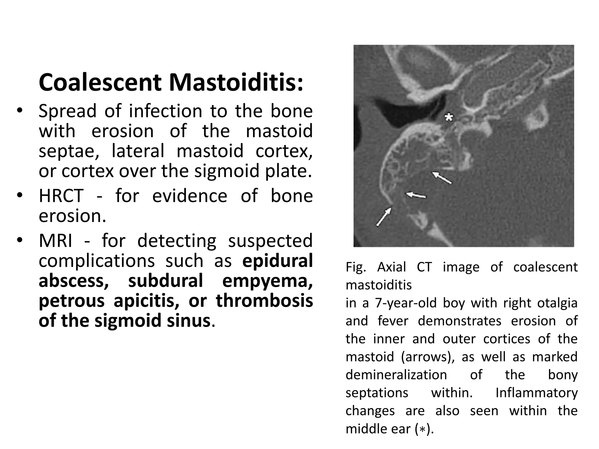 Mastoid diseases imaging | PPTX