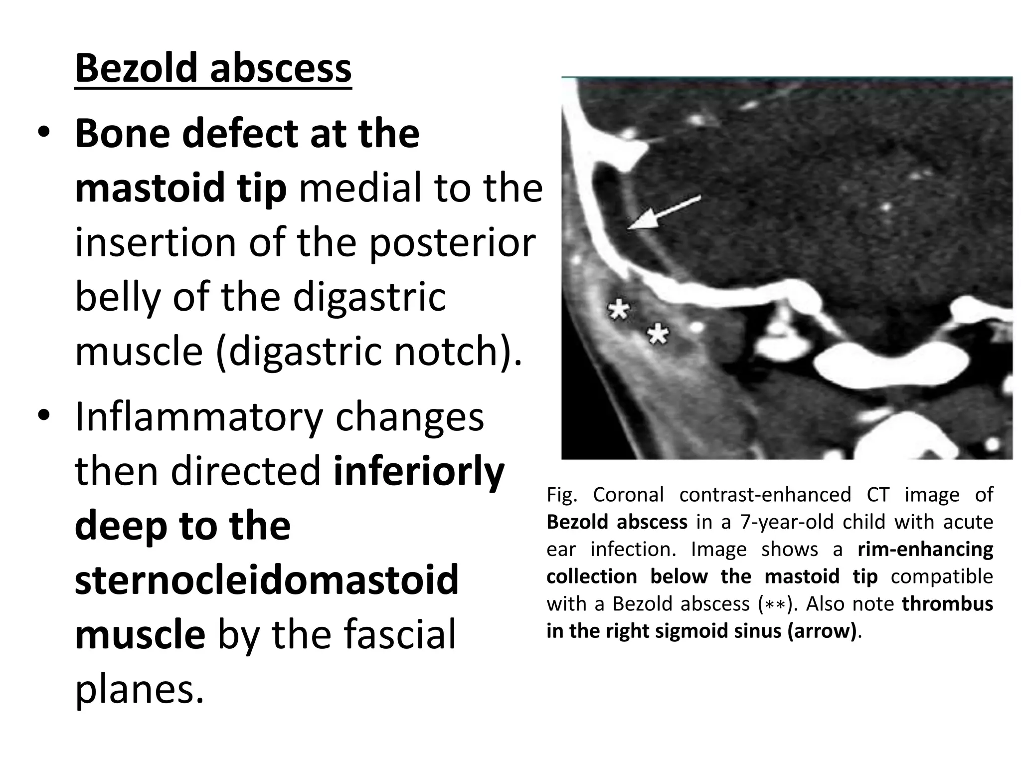 Mastoid diseases imaging | PPTX
