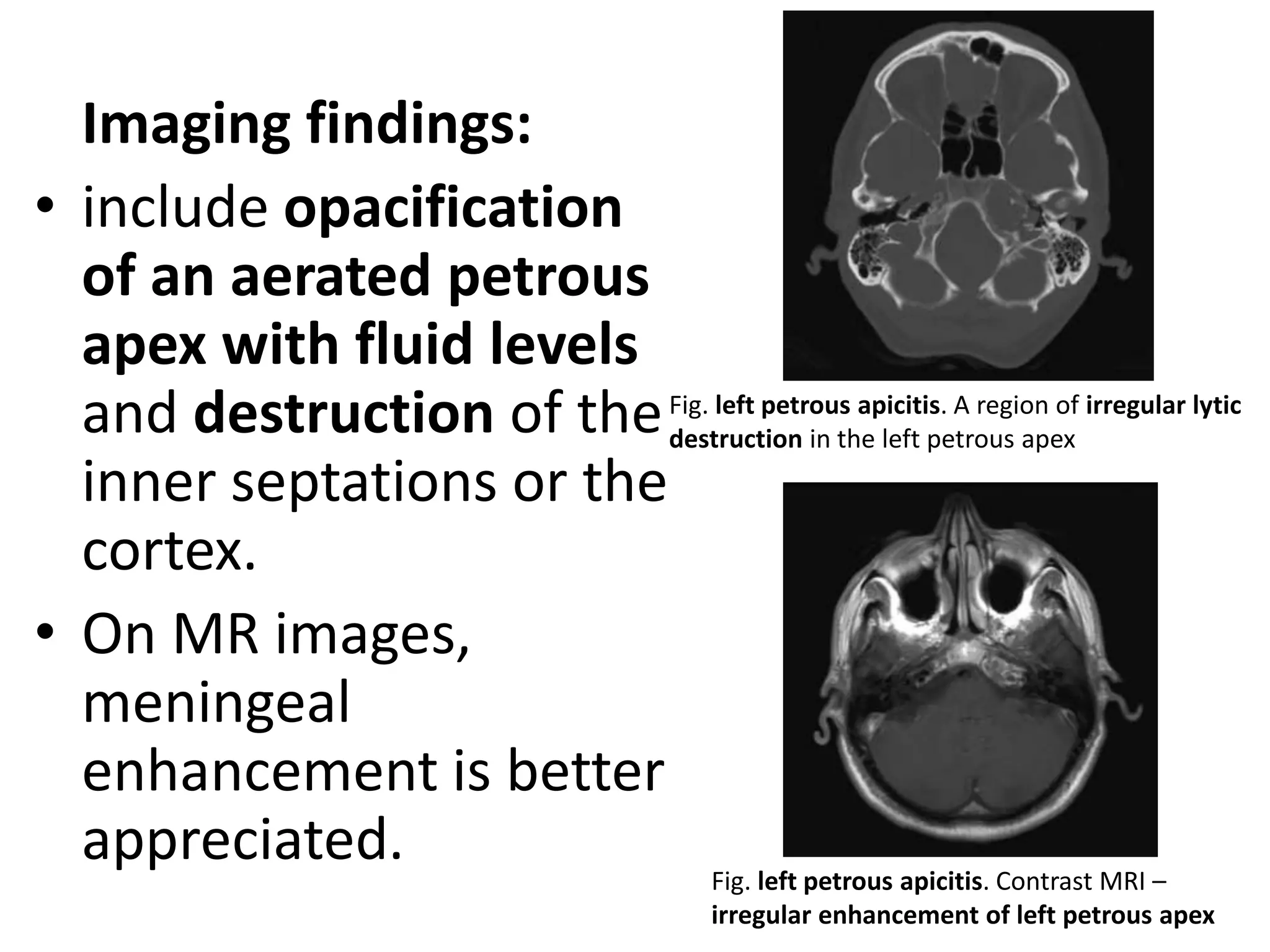 Mastoid diseases imaging | PPTX