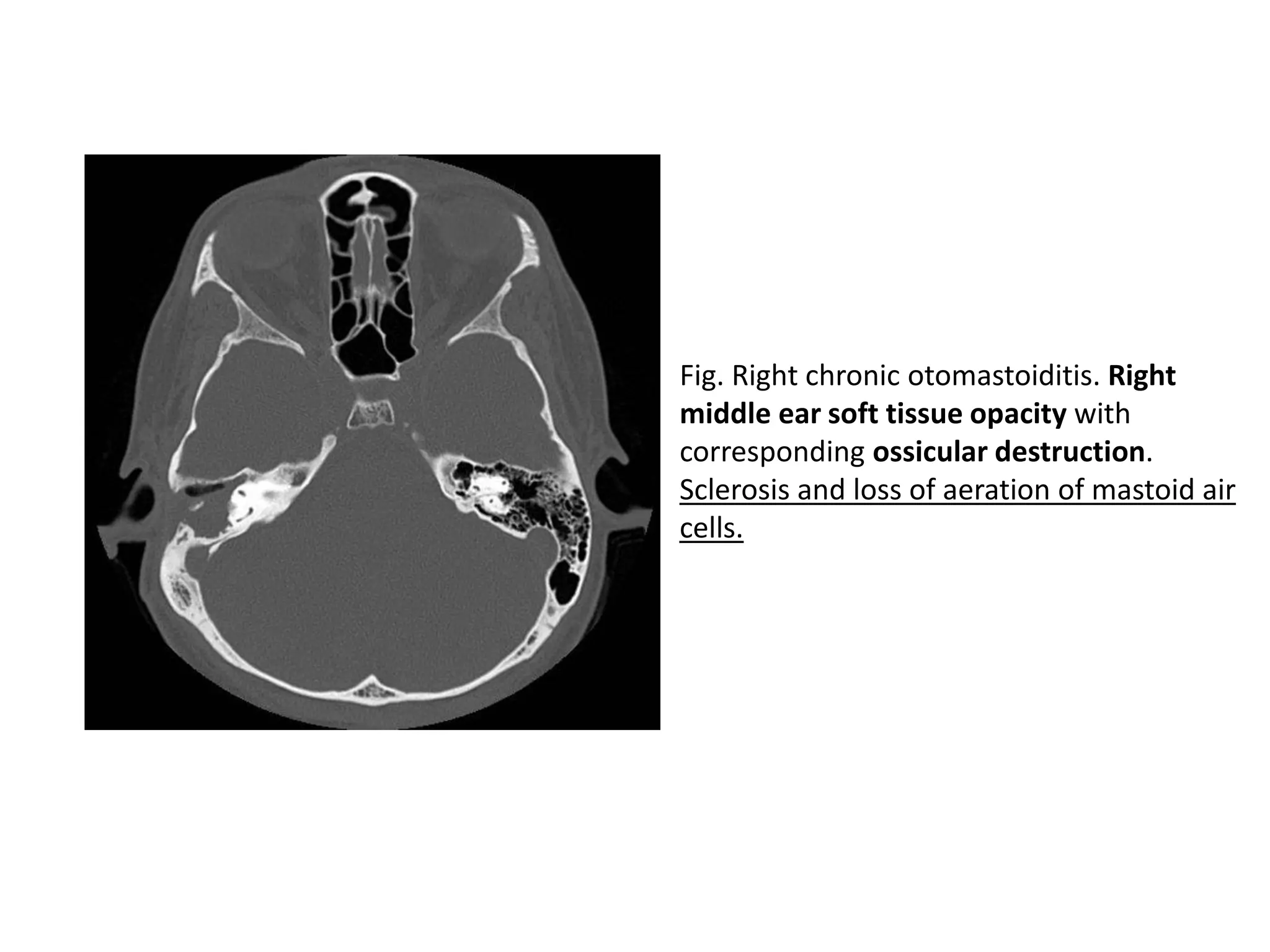 Mastoid diseases imaging | PPTX