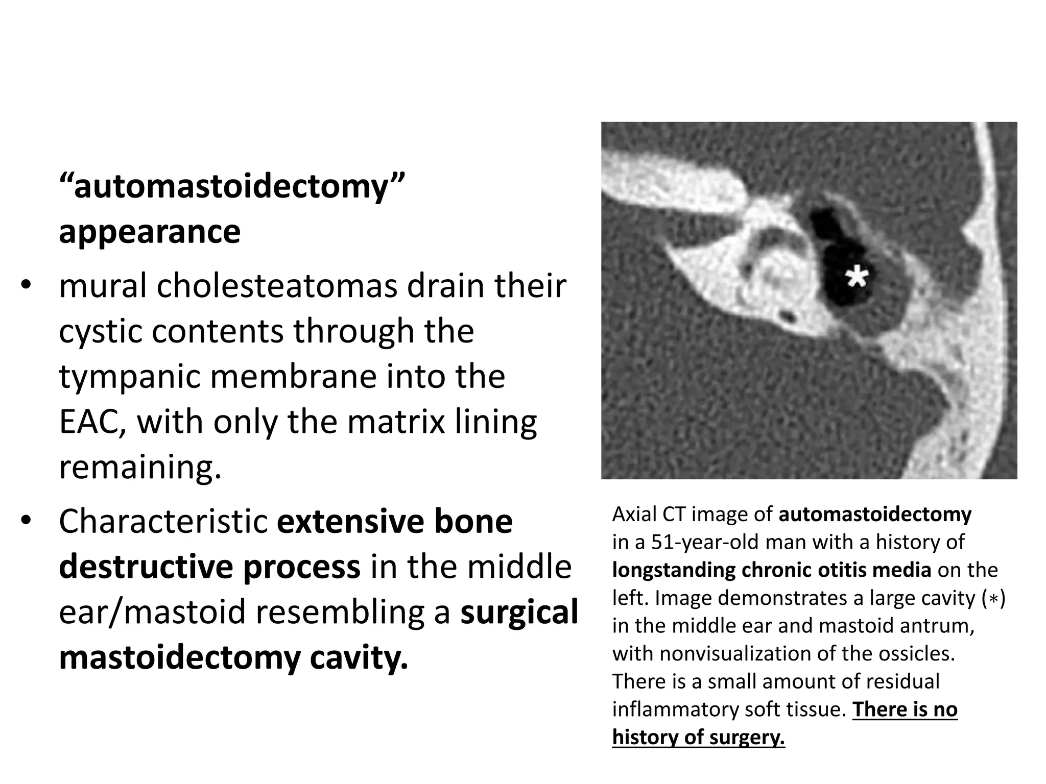 Mastoid diseases imaging | PPTX