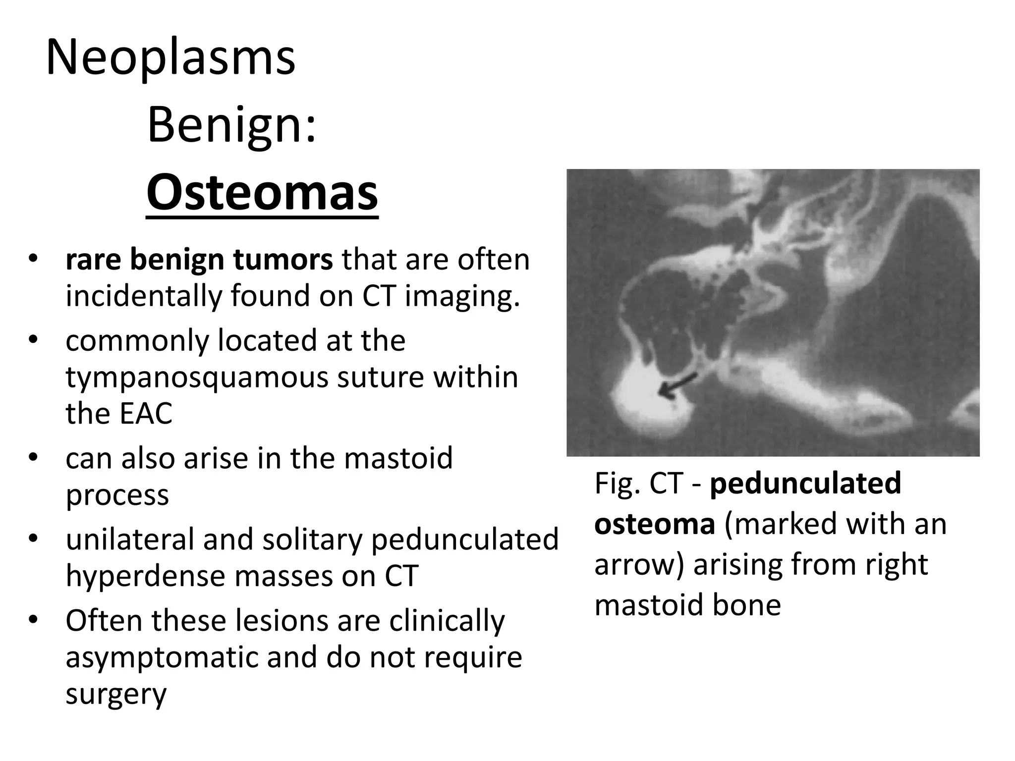 Mastoid diseases imaging | PPTX