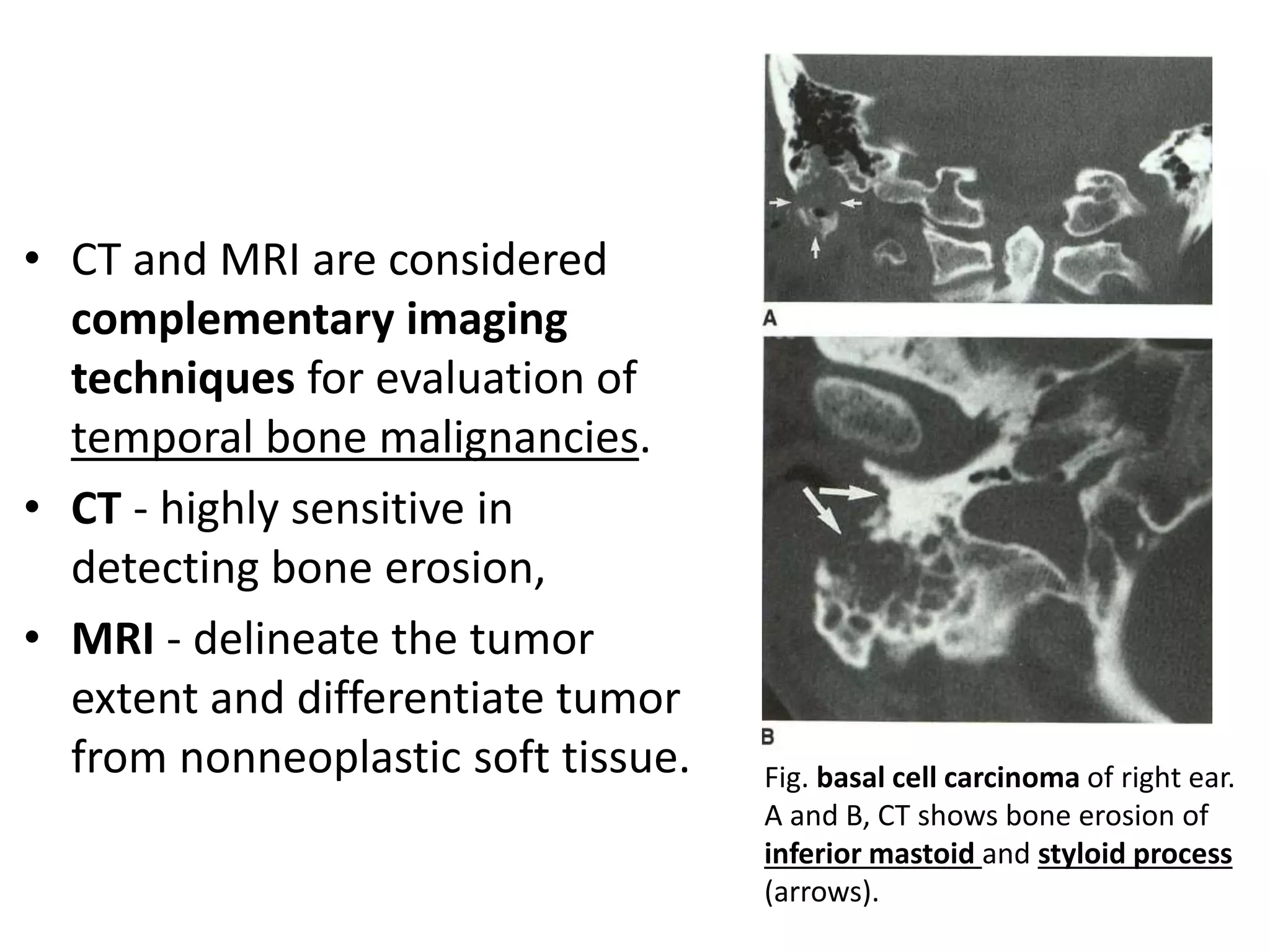 Mastoid diseases imaging | PPTX