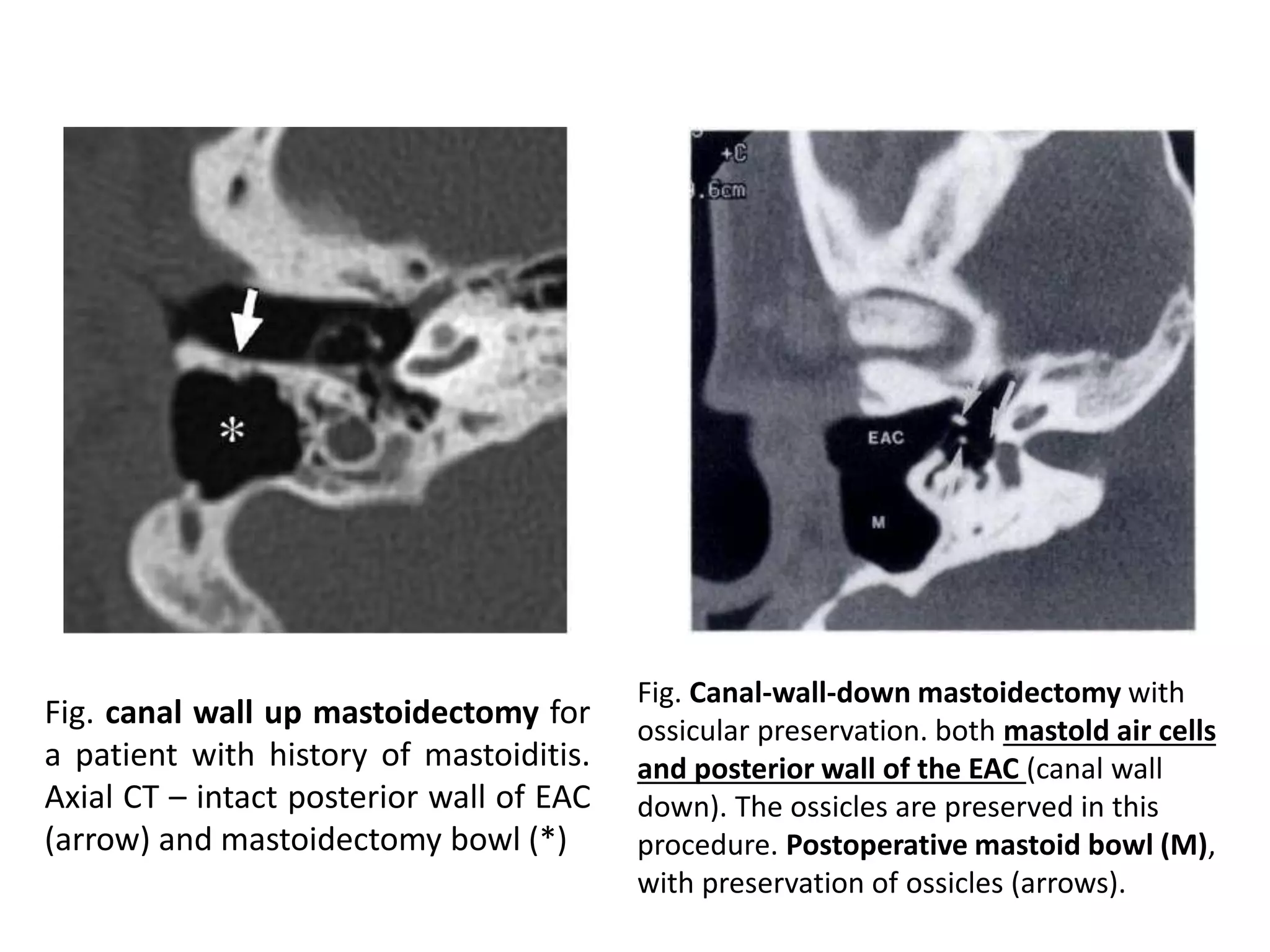 Mastoid diseases imaging | PPTX