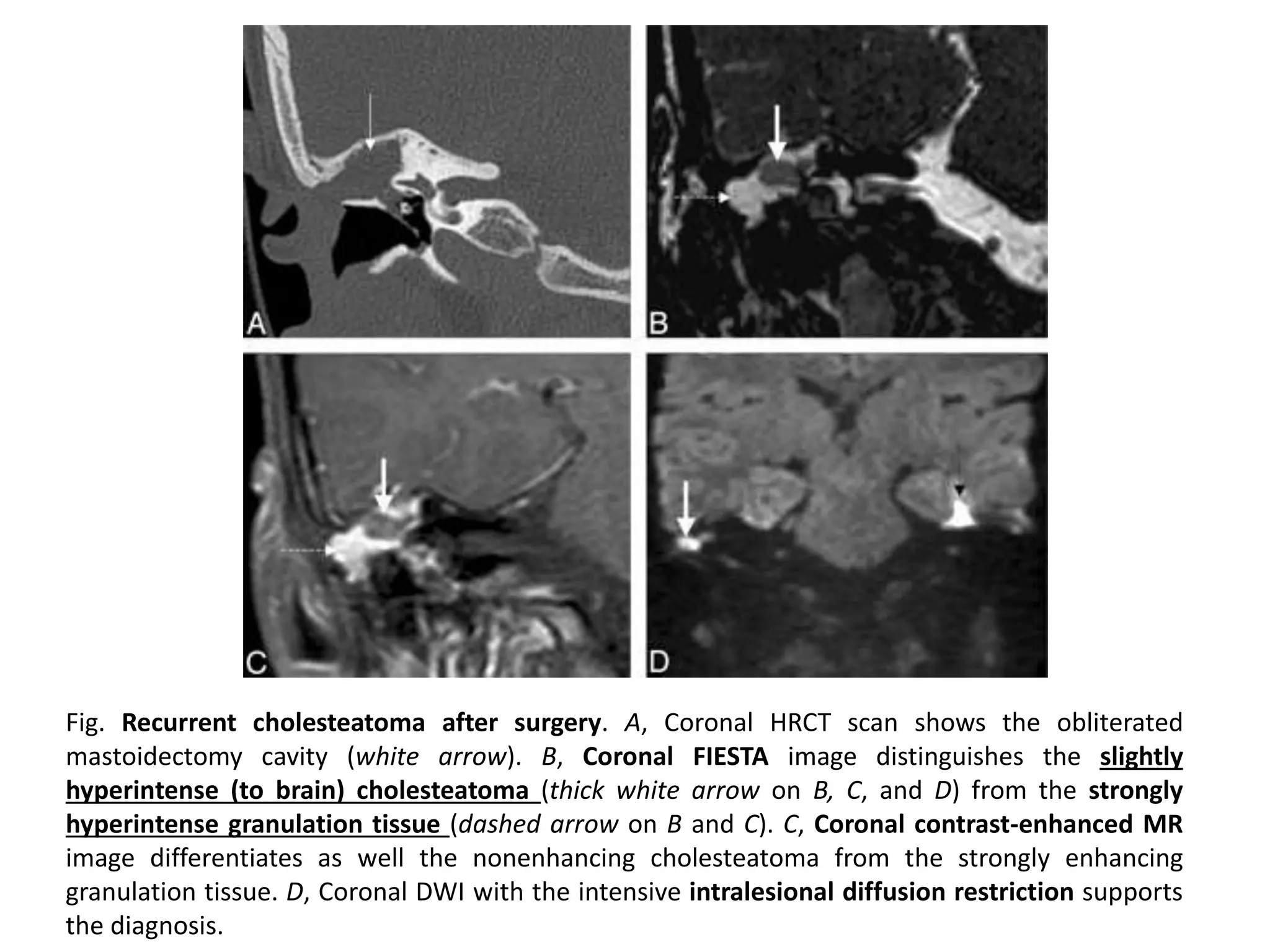 Mastoid diseases imaging | PPTX