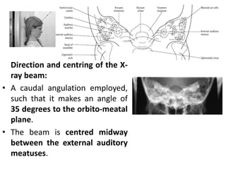 Mastoid diseases imaging | PPTX