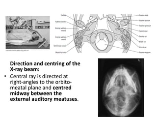 Mastoid diseases imaging | PPTX