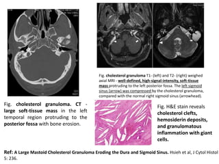 Mastoid diseases imaging | PPTX