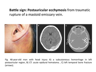 Mastoid diseases imaging | PPTX