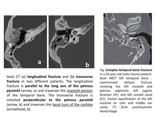 Mastoid diseases imaging | PPTX