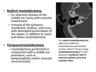 Mastoid diseases imaging | PPTX