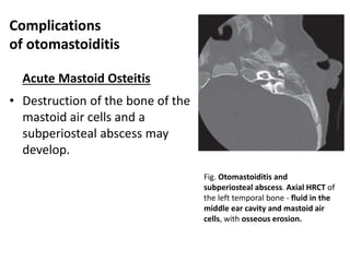 Mastoid Air Cells Fluid