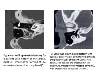 Mastoiditis X Ray
