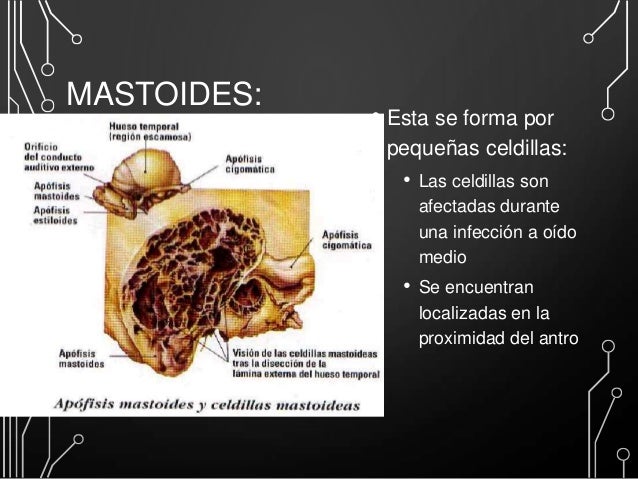 Mastoidectomía