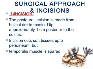 Mastoidectomy | PPT