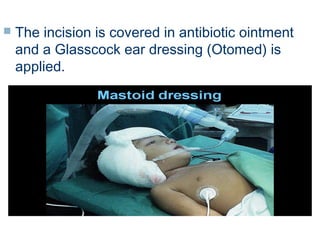 Mastoidectomy | PPT