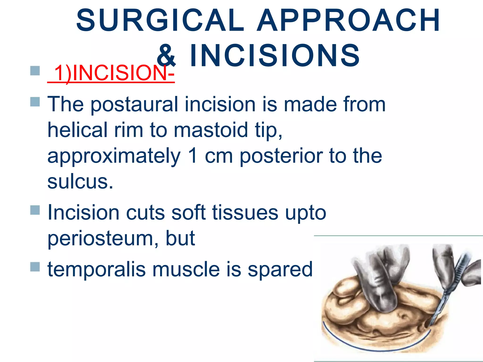 Mastoidectomy | PPT