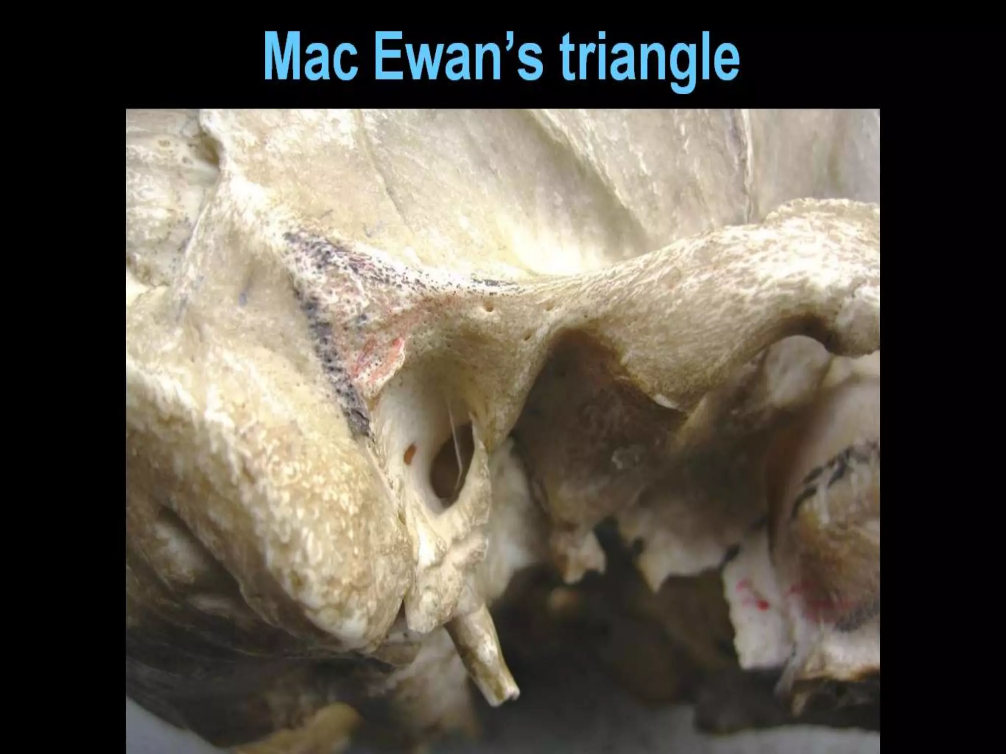 Mastoidectomy; Types, Indications, Procedure | PDF