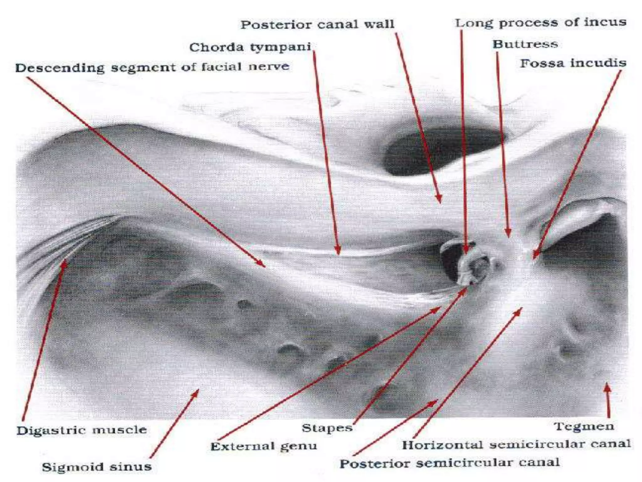Mastoidectomy; Types, Indications, Procedure | PDF