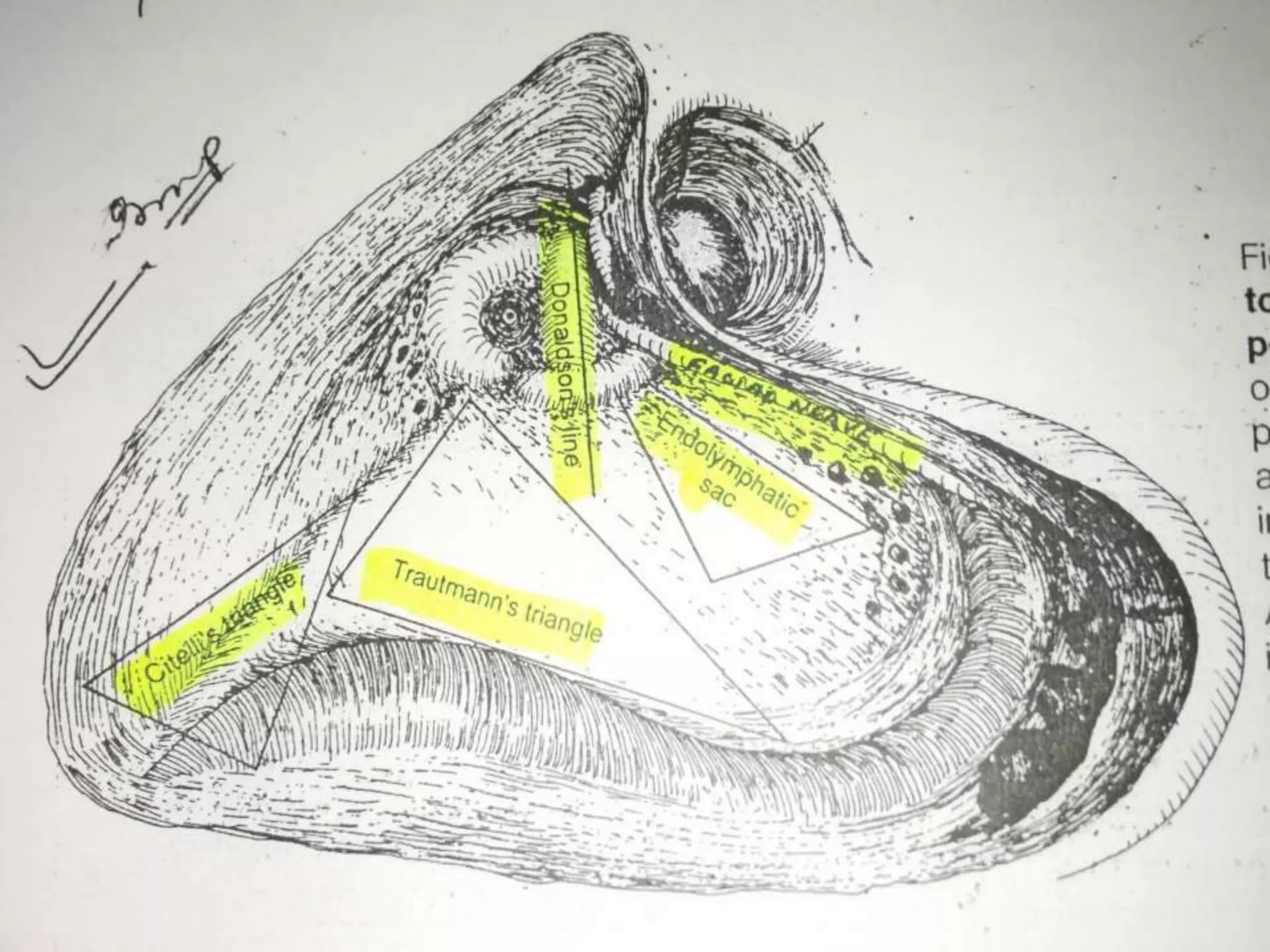 Mastoidectomy; Types, Indications, Procedure | PDF