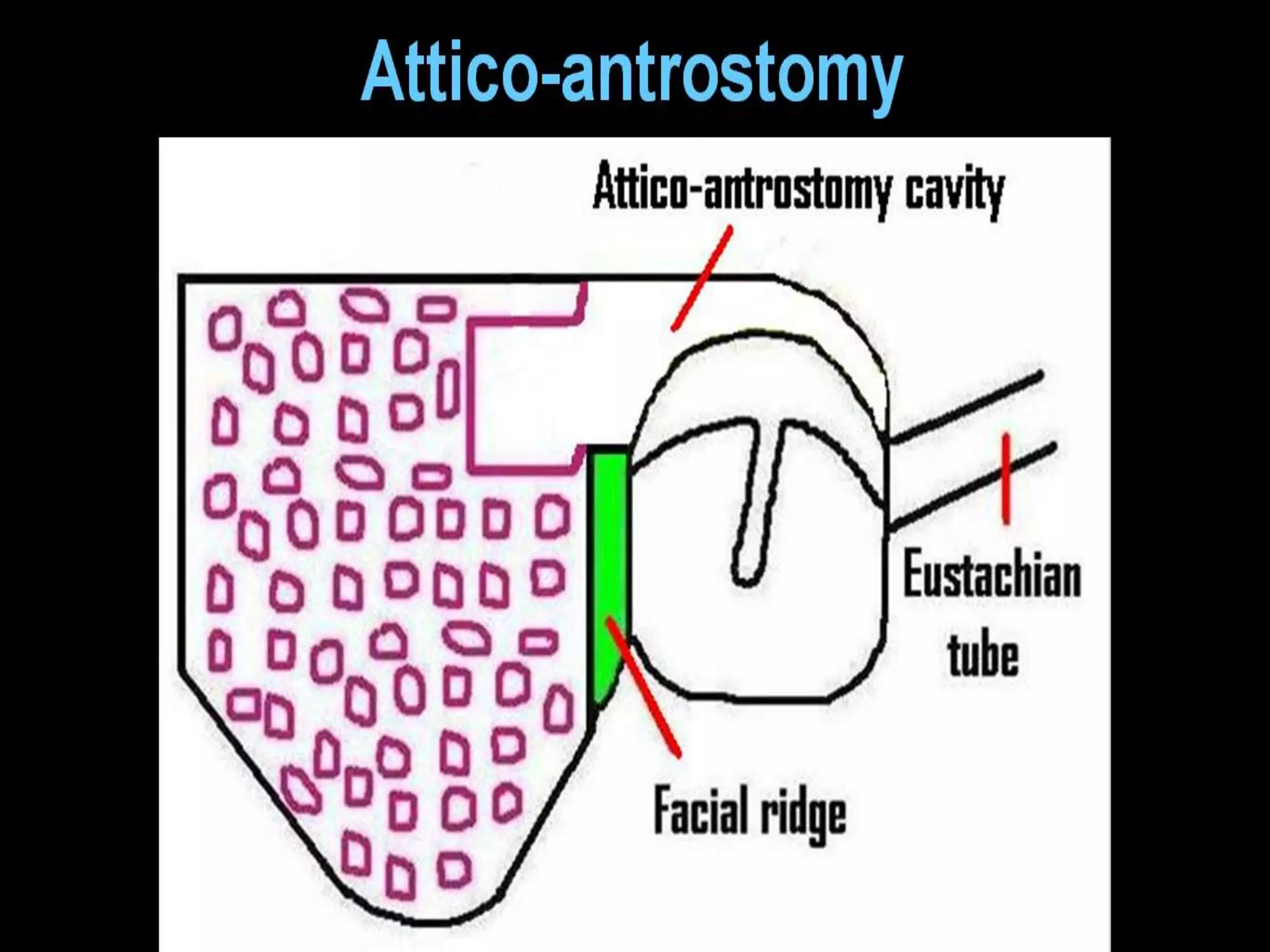 Mastoidectomy; Types, Indications, Procedure | PDF