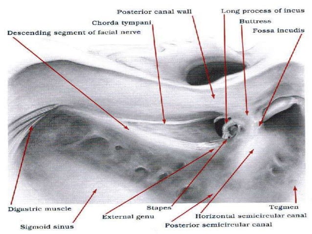 Mastoidectomy; Types, Indications, Procedure | PDF