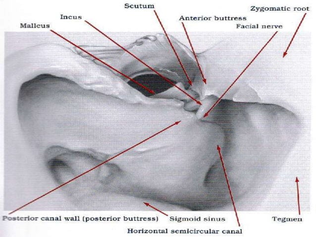 Mastoidectomy; Types, Indications, Procedure | PDF