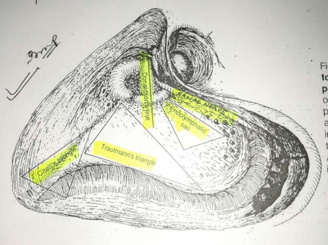 Mastoidectomy; Types, Indications, Procedure | PDF