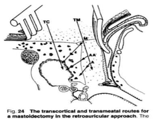 Mastoidectomy; Types, Indications, Procedure | PDF