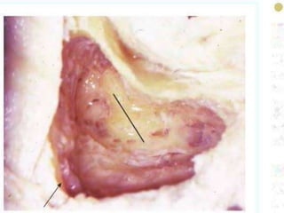 Mastoidectomy; Types, Indications, Procedure | PDF