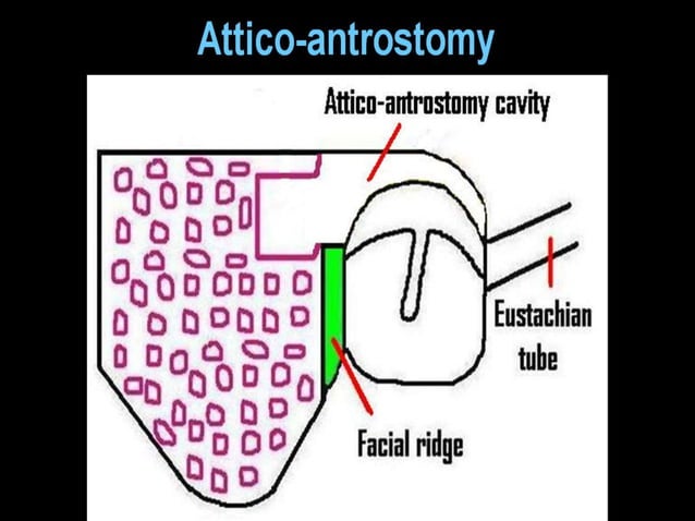 Mastoidectomy; Types, Indications, Procedure | PDF