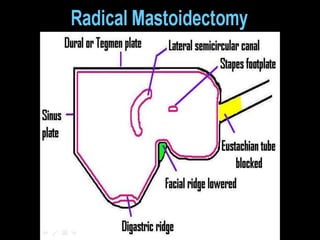 Mastoidectomy; Types, Indications, Procedure | PDF