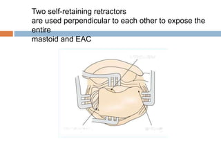 Mastoidectomy; Types, Indications, Procedure | PDF