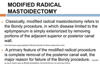 Mastoidectomy; Types, Indications, Procedure | PDF