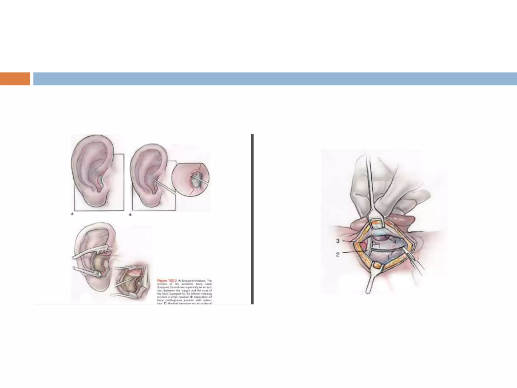 Mastoidectomy | PPTX