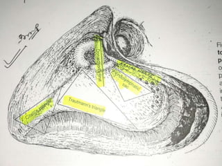 Mastoidectomy | PPTX