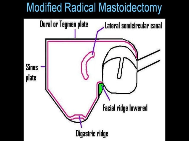 Mastoidectomy | PPTX