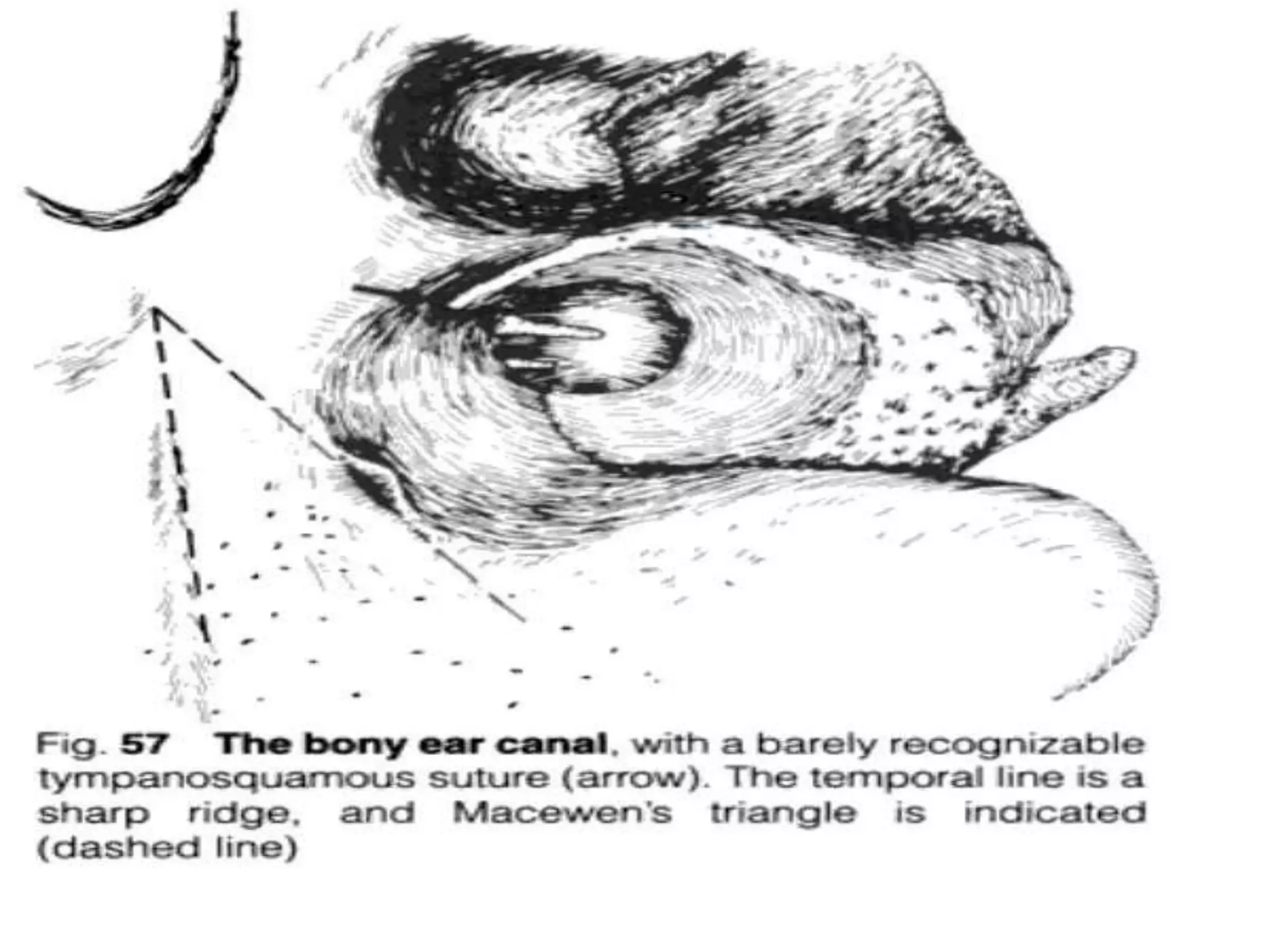 Mastoidectomy (by drdhiru456) | PPTX