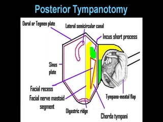 Facial Recess Approach